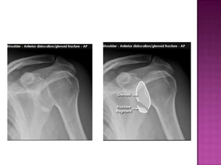 Radiographic positioning of humerus and shoulder | PPTX