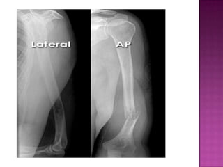 Radiographic positioning of humerus and shoulder | PPTX