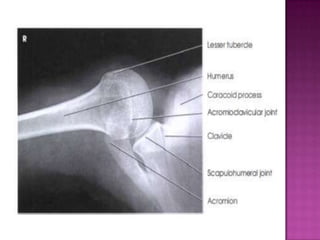 Humerus Anatomy X Ray