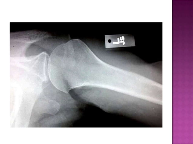 Radiographic positioning of humerus and shoulder