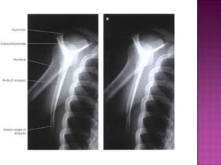 Radiographic Positioning Humerus Ap And Lateral