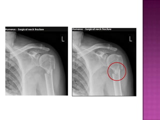 Shoulder X Ray Positions