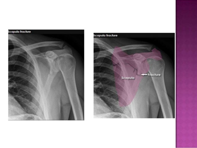 Radiographic positioning of humerus and shoulder