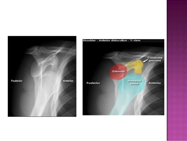 Radiographic positioning of humerus and shoulder