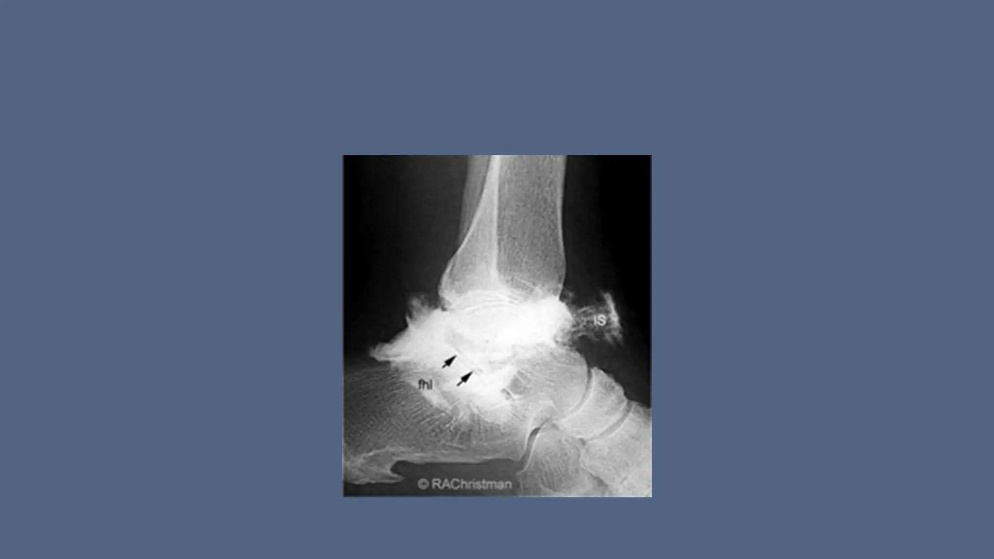 Radiographic procedure arthogram.....pptx