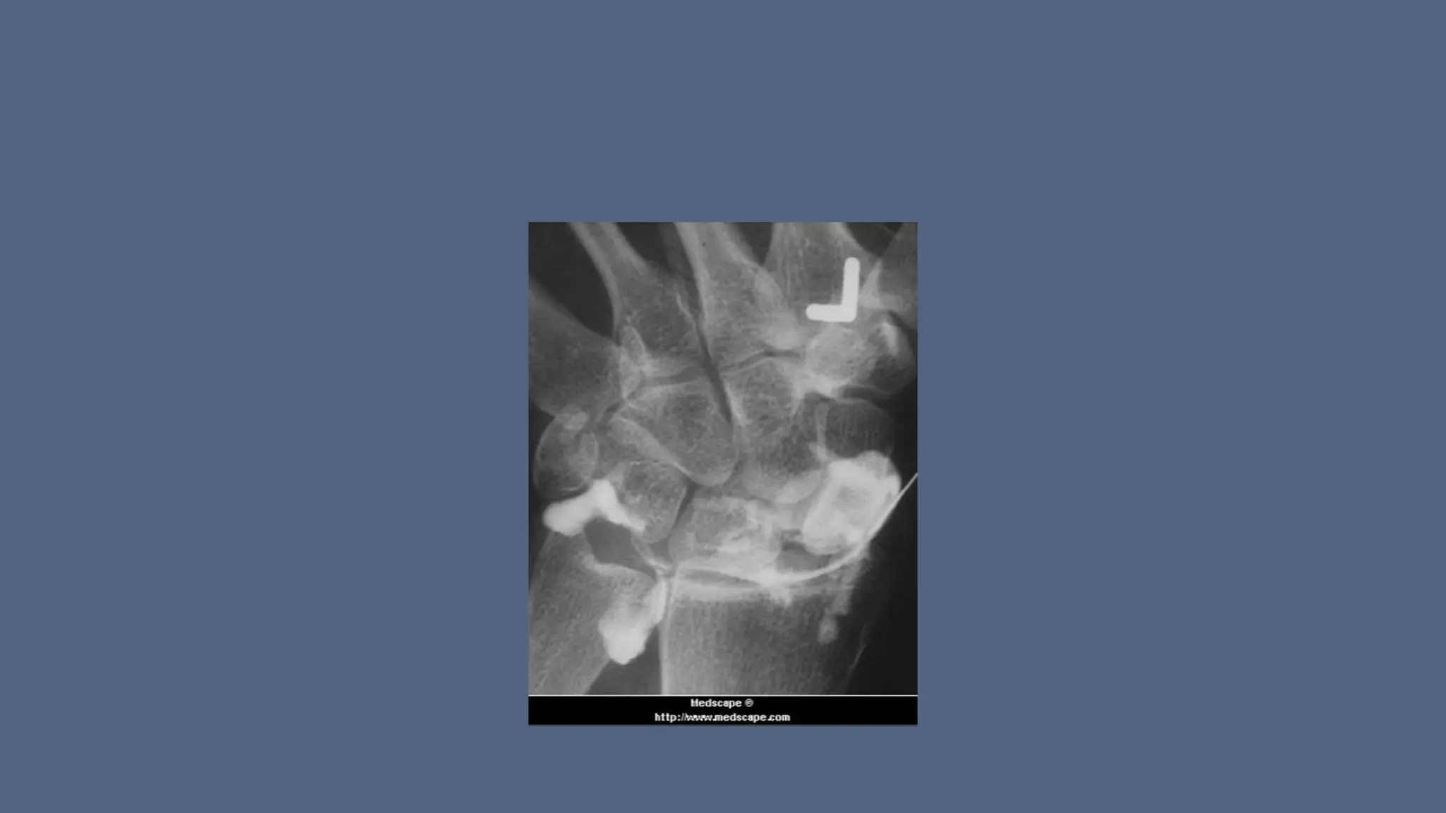 Radiographic procedure arthogram.....pptx