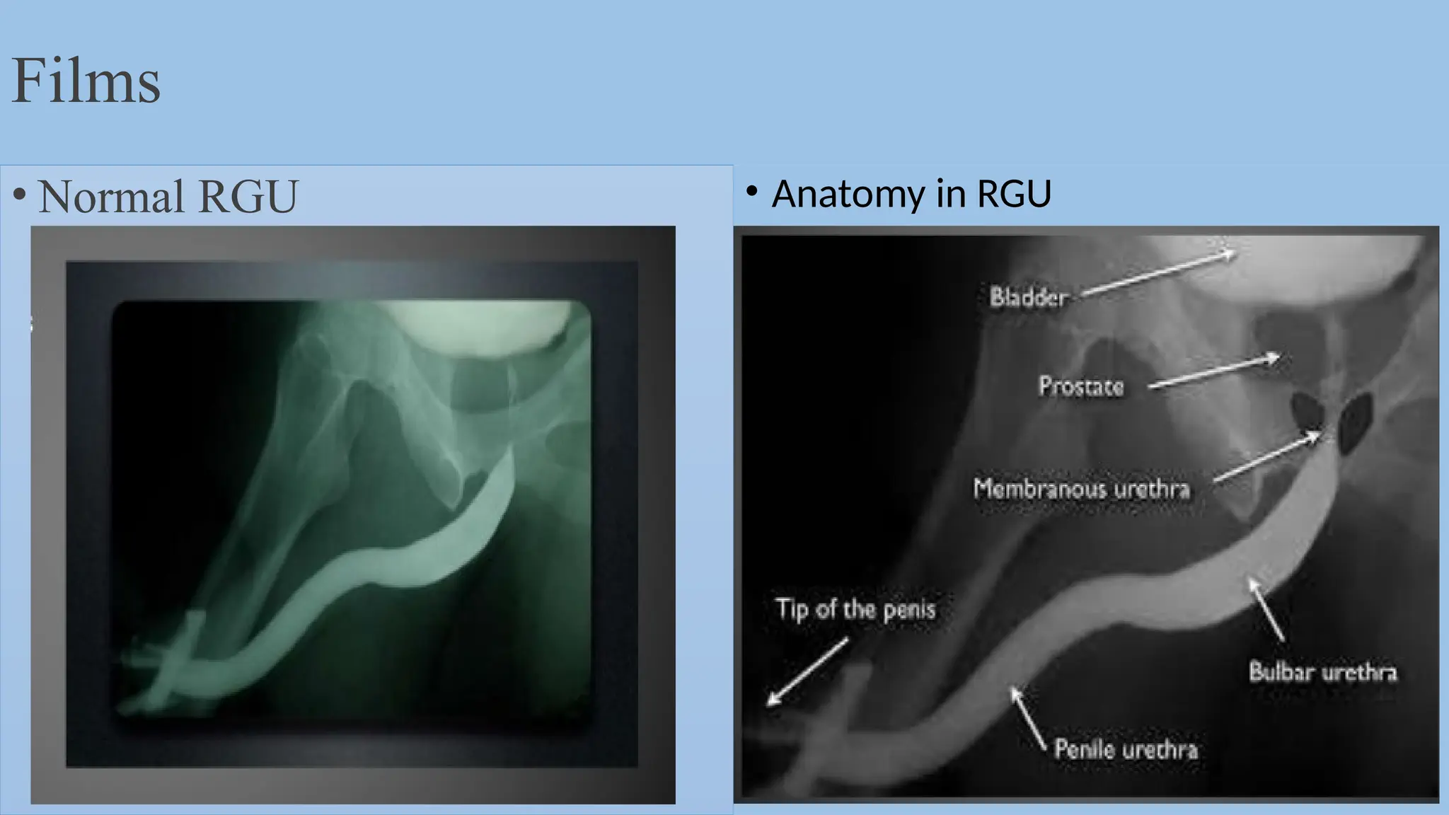 Radiographic Procedure (RGU & MCUG) - Saroj.pptx