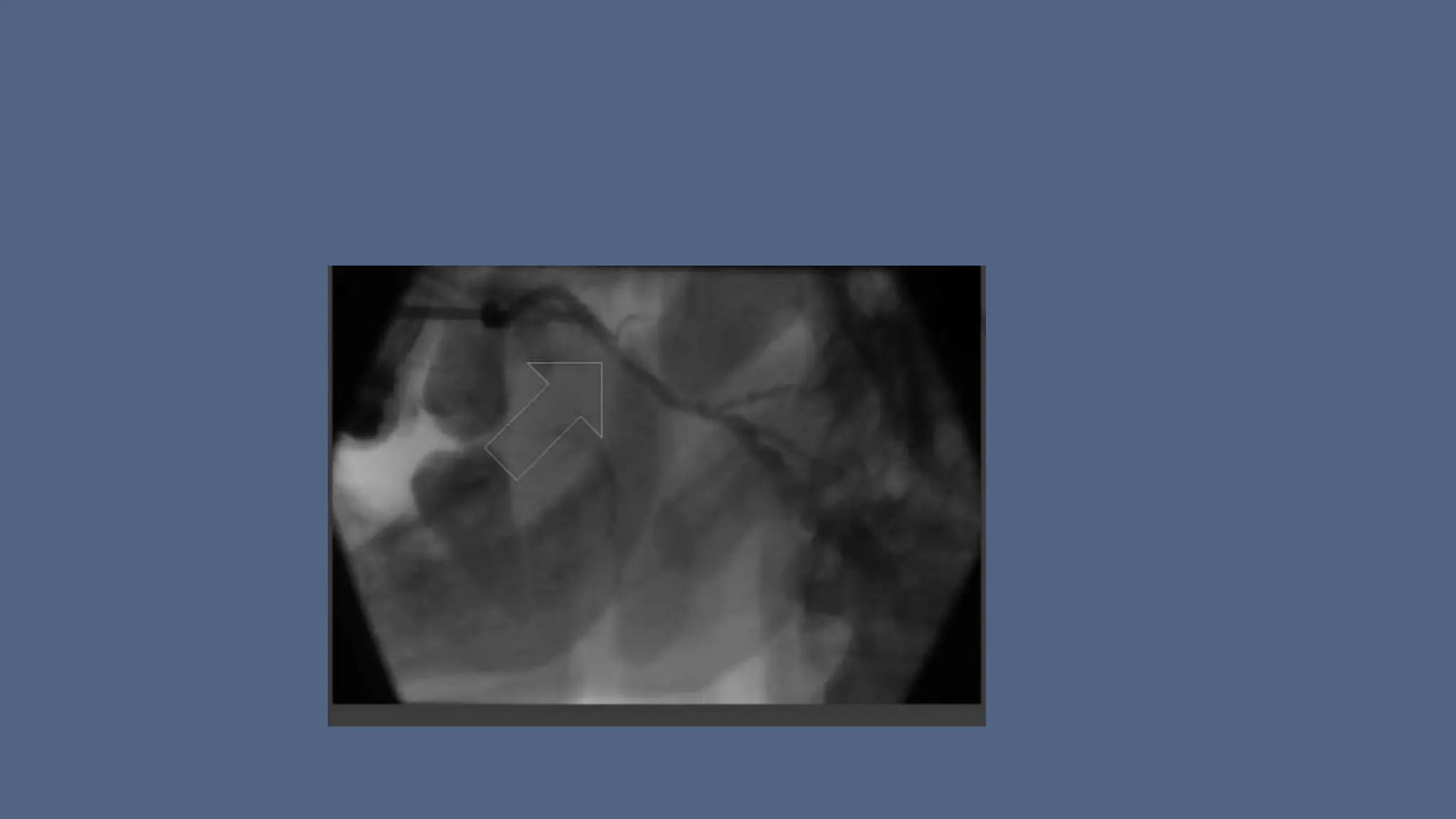 Radiographic procedure sailograp.....hy.pptx