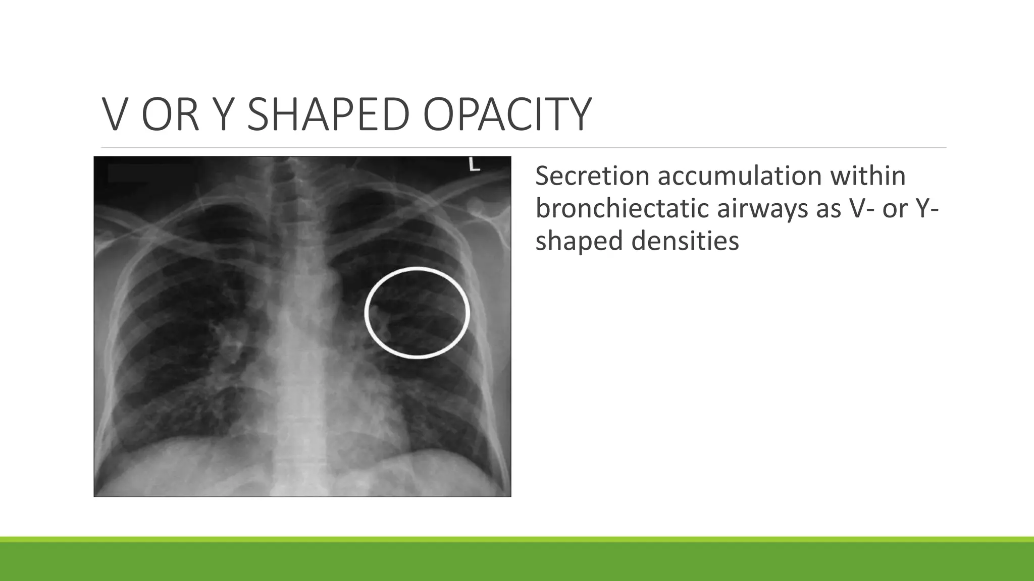 Radiographic signs in bronchiectasis | PPTX