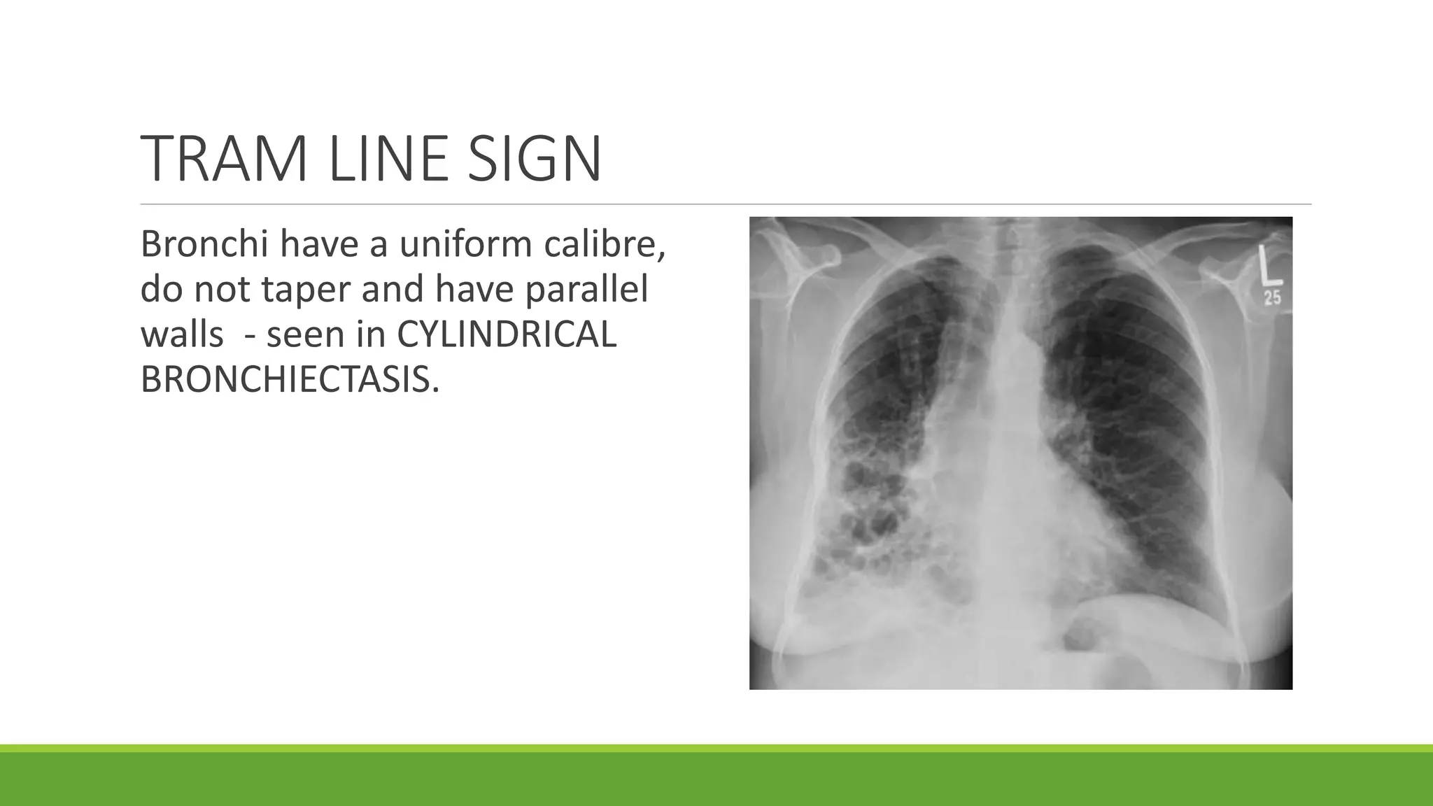 Radiographic signs in bronchiectasis | PPTX