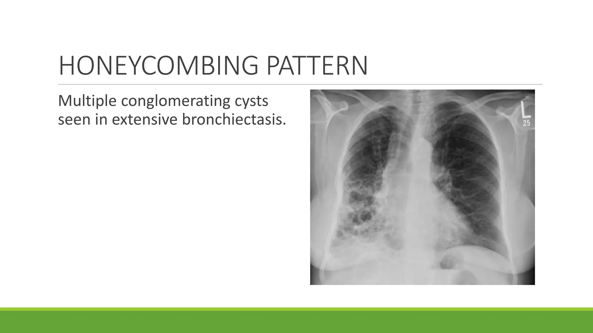 Radiographic signs in bronchiectasis | PPTX