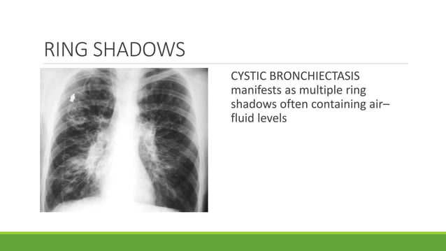 Radiographic signs in bronchiectasis | PPTX