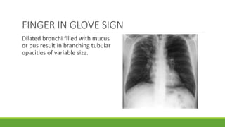 Radiographic signs in bronchiectasis | PPT