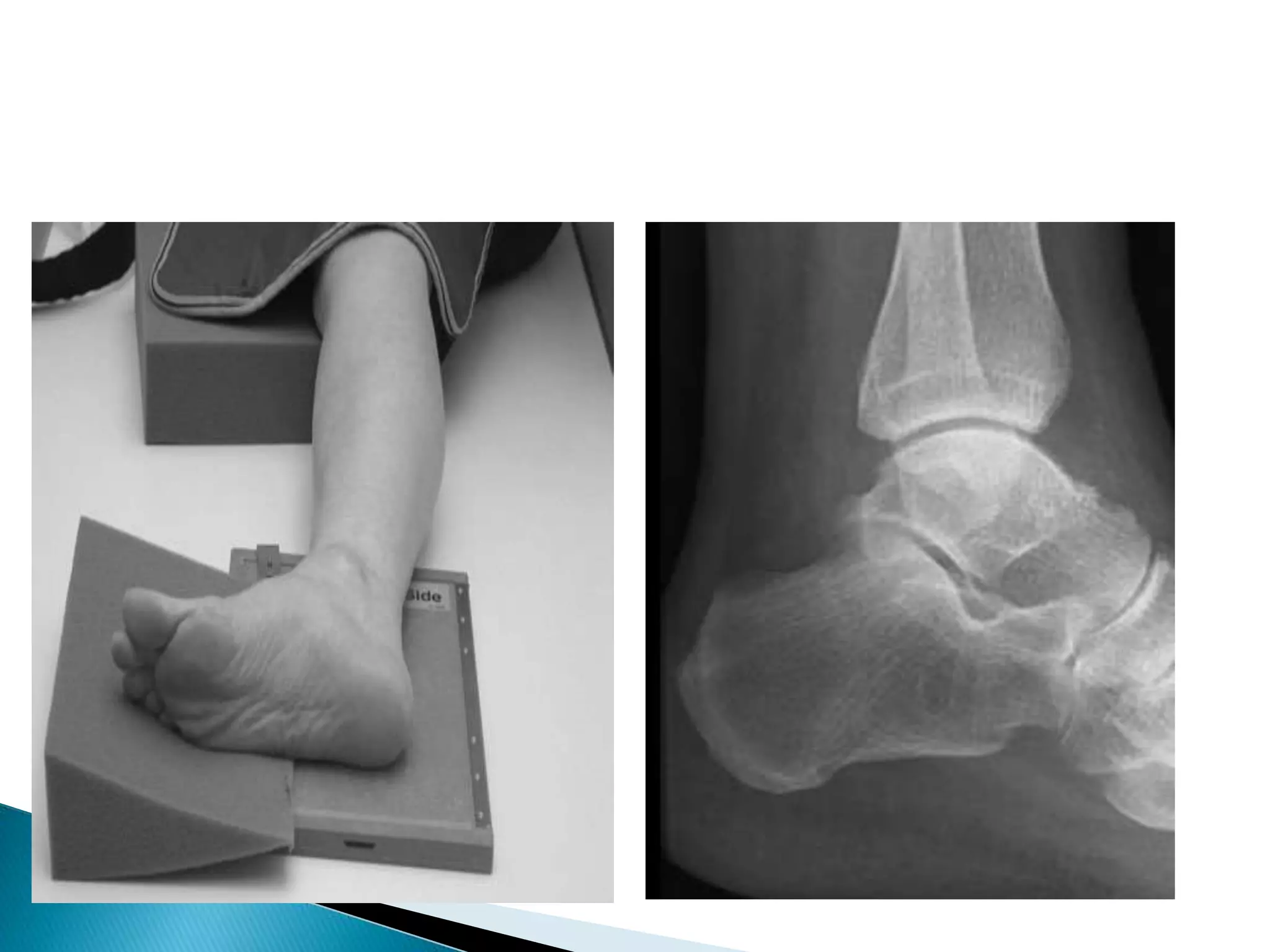 RADIOGRAPHIC TECHNIQUE FOOT.pptx