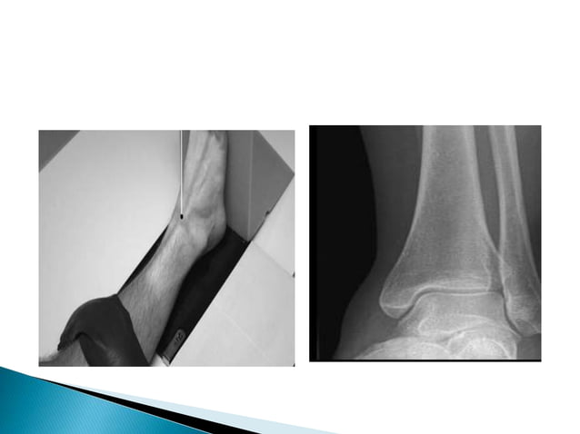 RADIOGRAPHIC TECHNIQUE FOOT.pptx