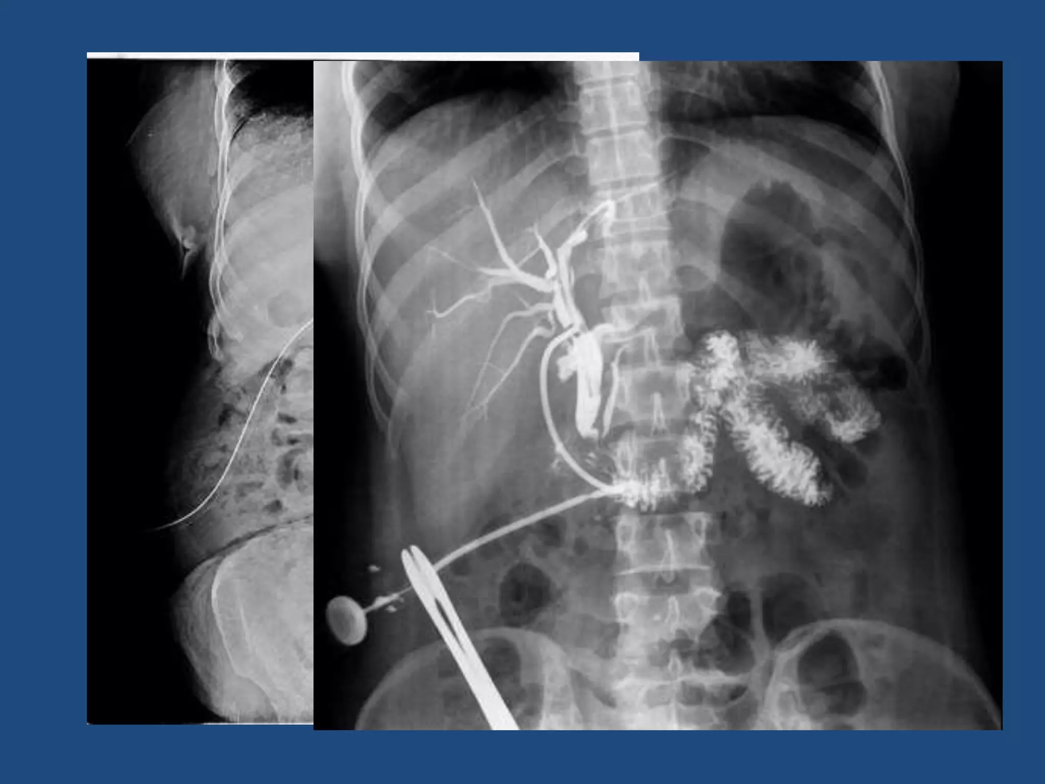 Radiographic technique of biliary system | PPTX