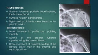RADIOGRAPHIC TECHNIQUE OF SHOULDER(1).pptx
