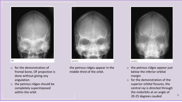 Radiographic technique of skull | PPTX