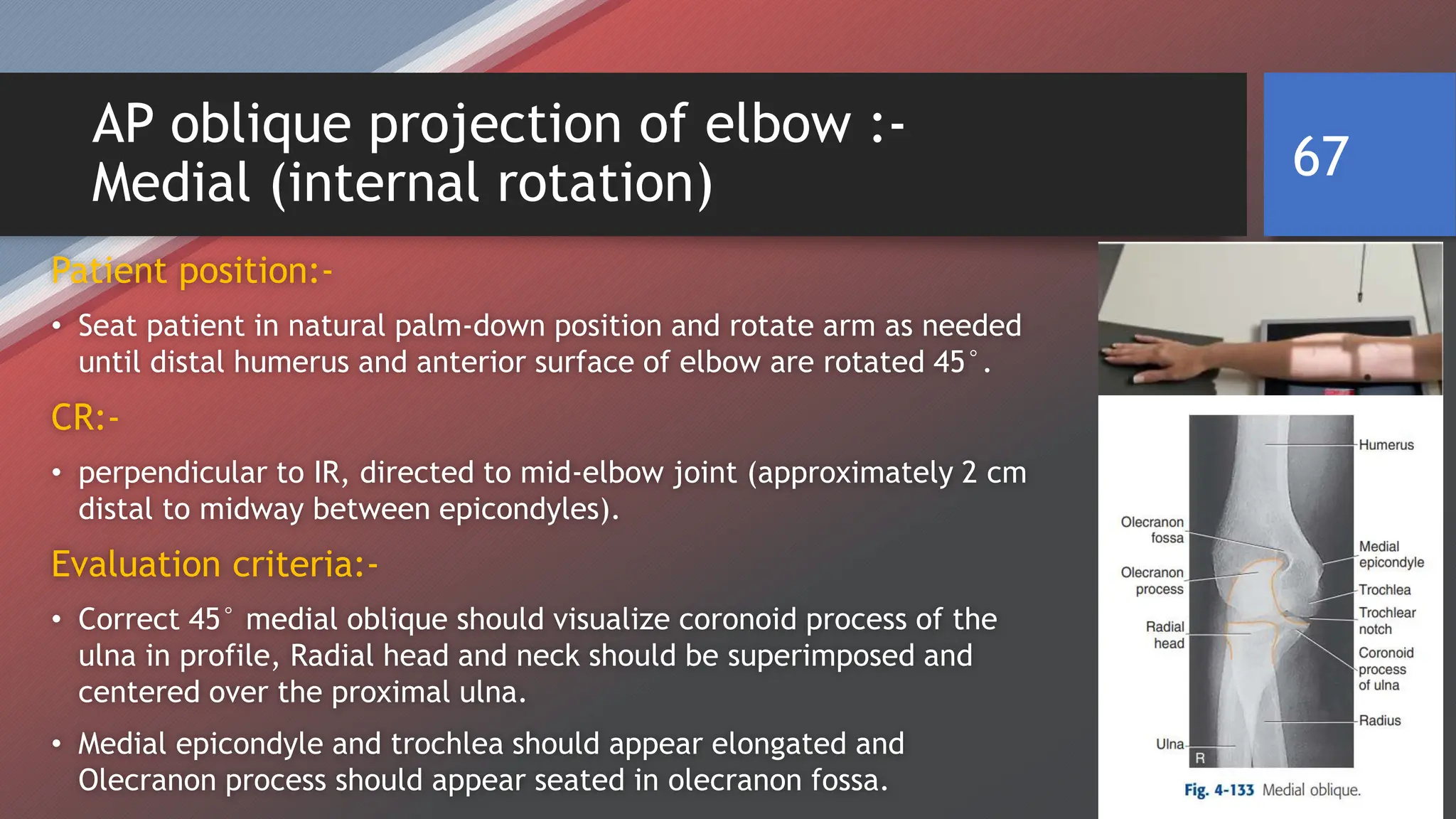 RADIOGRAPHIC TECHNIQUE OF UPPER LIMB BY SAGAR CHAULAGAIN | PPTX
