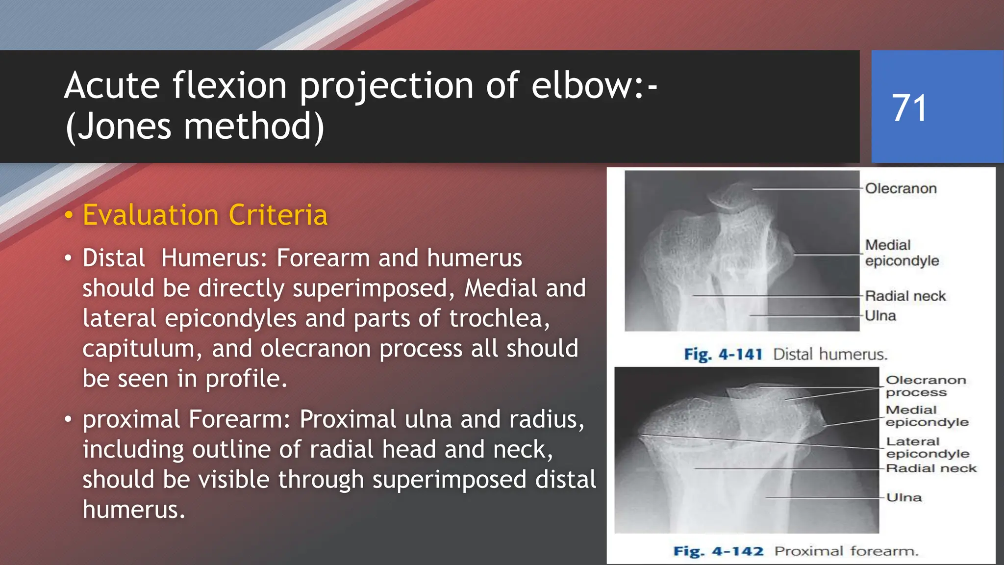 RADIOGRAPHIC TECHNIQUE OF UPPER LIMB BY SAGAR CHAULAGAIN | PPTX