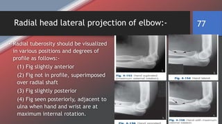 RADIOGRAPHIC TECHNIQUE OF UPPER LIMB BY SAGAR CHAULAGAIN | PPTX
