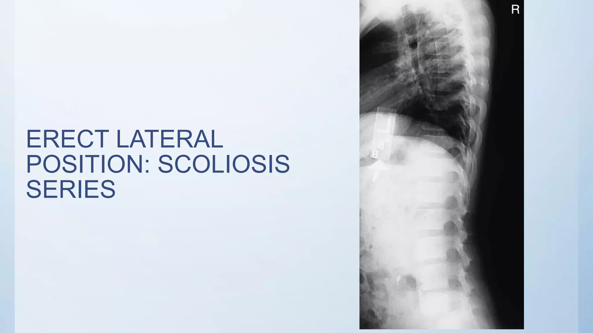 Radiographic views of lumbar spine | PPTX