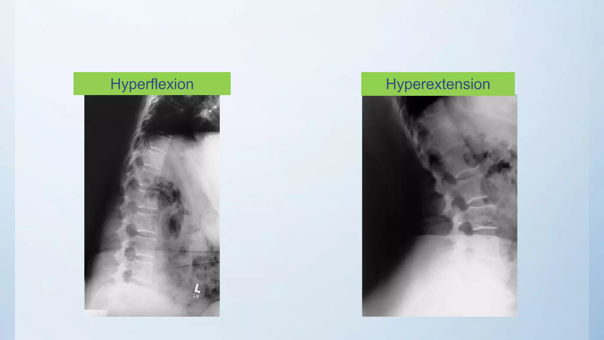 Radiographic views of lumbar spine | PPTX