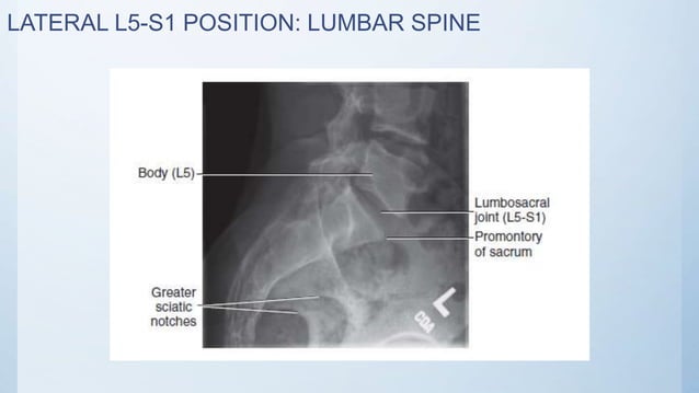 Radiographic views of lumbar spine | PPTX