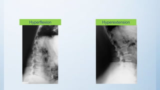 Radiographic views of lumbar spine | PPTX