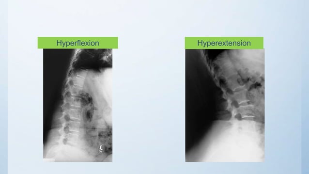 Radiographic views of lumbar spine | PPTX