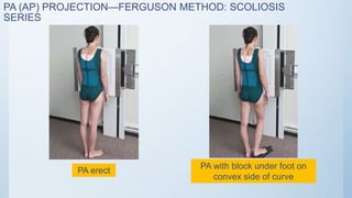 Ferguson View Of Lumbar Spine