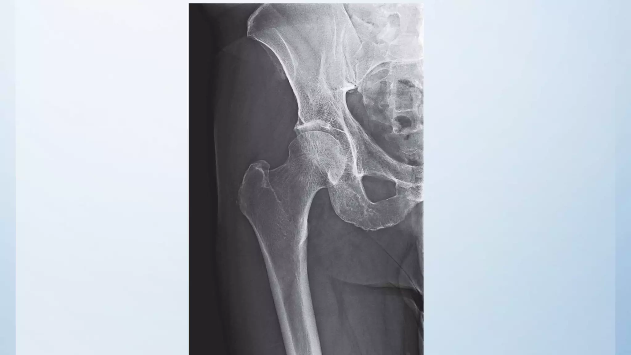 Radiographic views of proximal femur and pelvis | PPTX