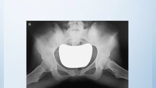 Radiographic views of proximal femur and pelvis | PPTX