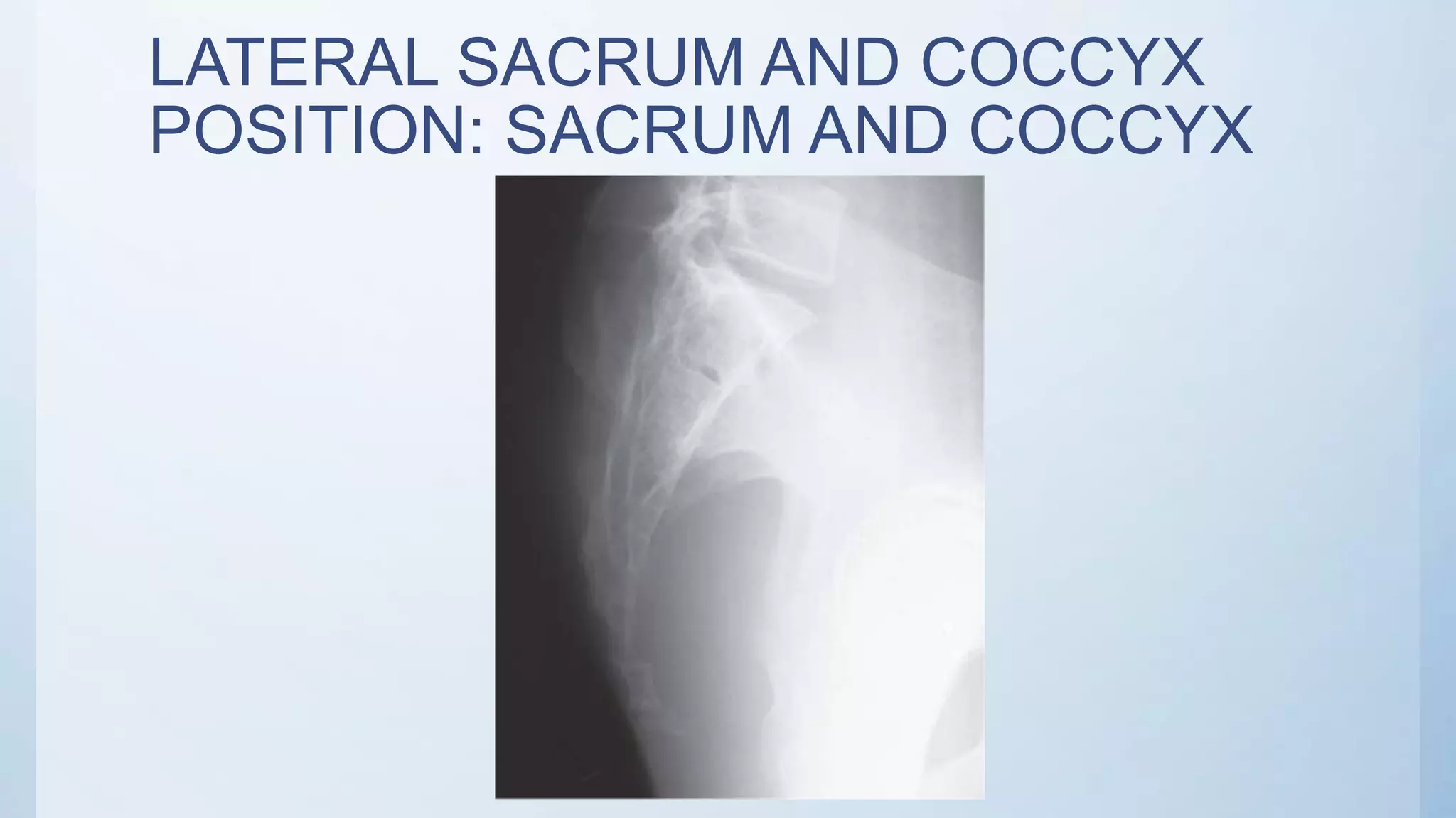 Radiographic views of sacrum and coccyx | PPTX