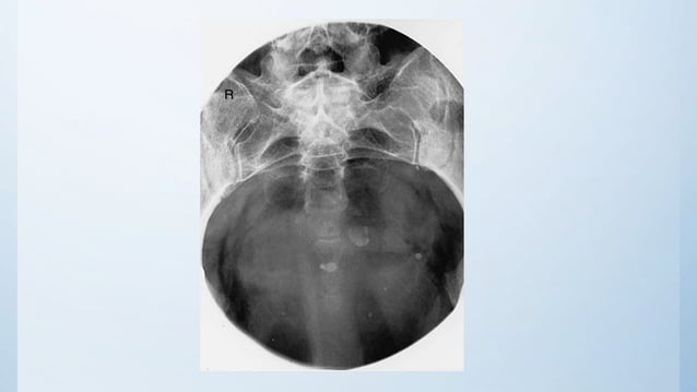 Radiographic views of sacrum and coccyx | PPTX
