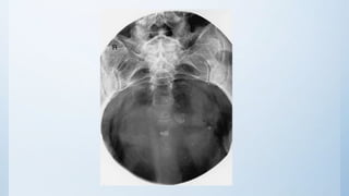 Sacrum Anatomy Xray