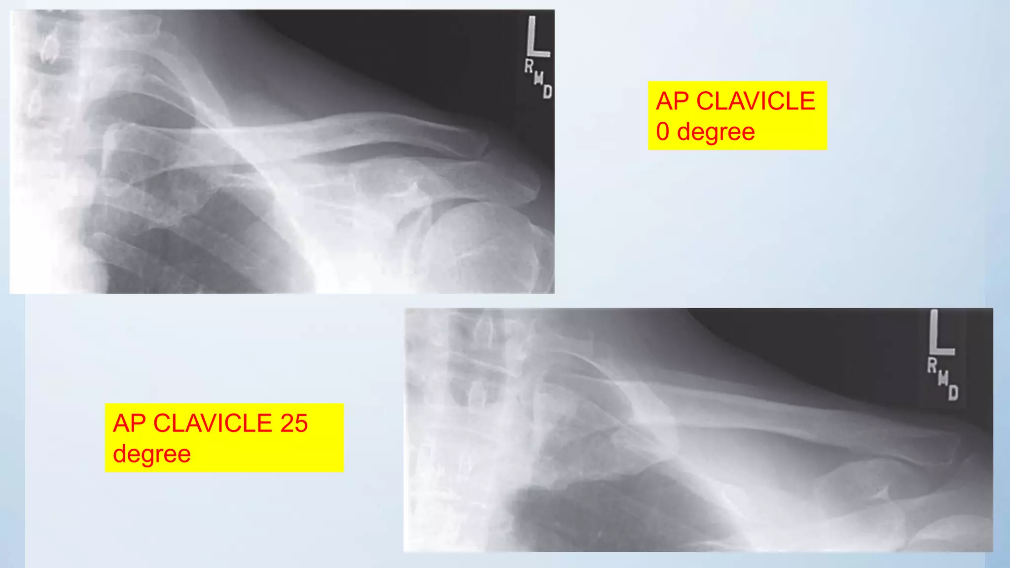 X ray views of shoulder joint and related structures | PPTX