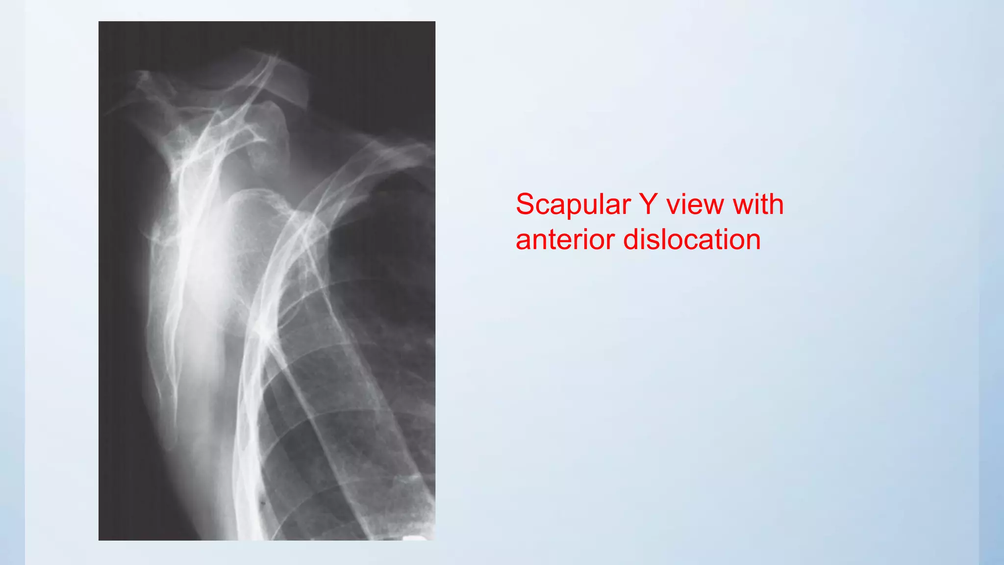 X ray views of shoulder joint and related structures | PPTX