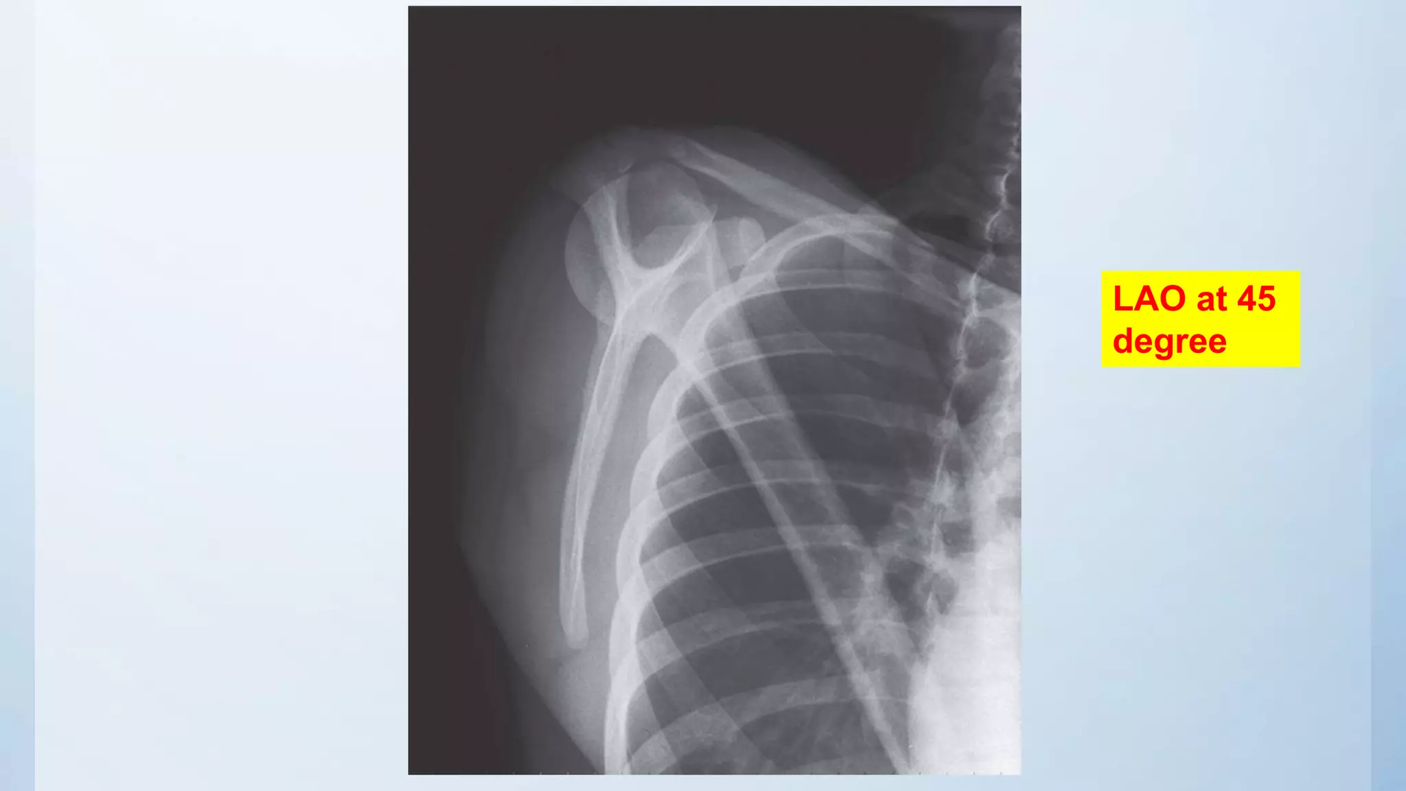 X ray views of shoulder joint and related structures | PPTX