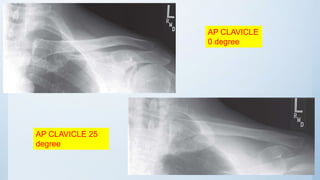 X ray views of shoulder joint and related structures | PPTX