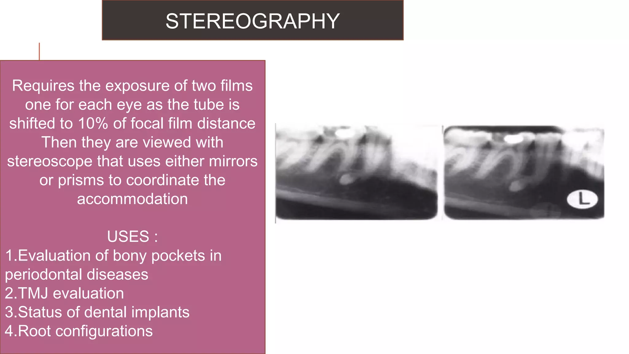 Radiographs in endodontic diagnosis | PPT