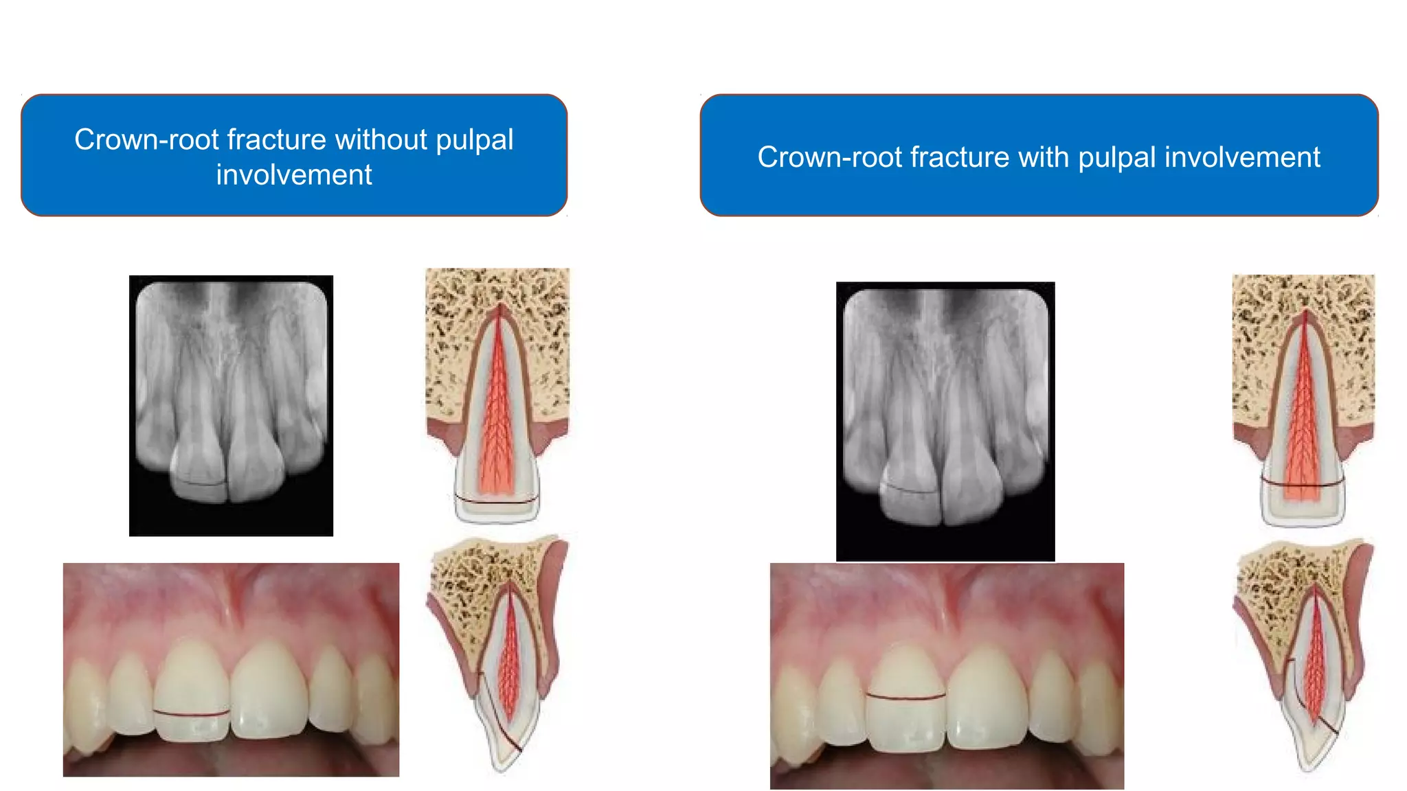 Radiographs in endodontic diagnosis | PPT