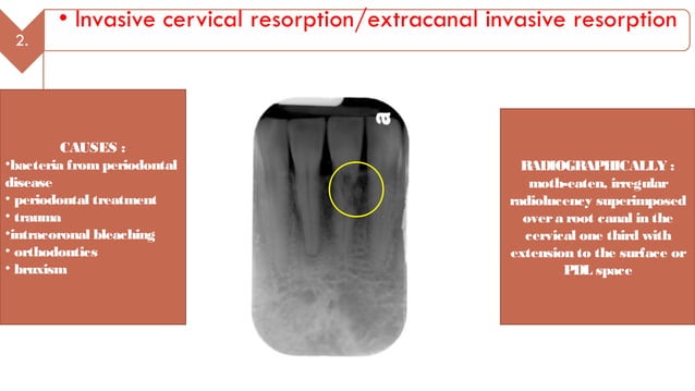 Radiographs in endodontic diagnosis | PPT