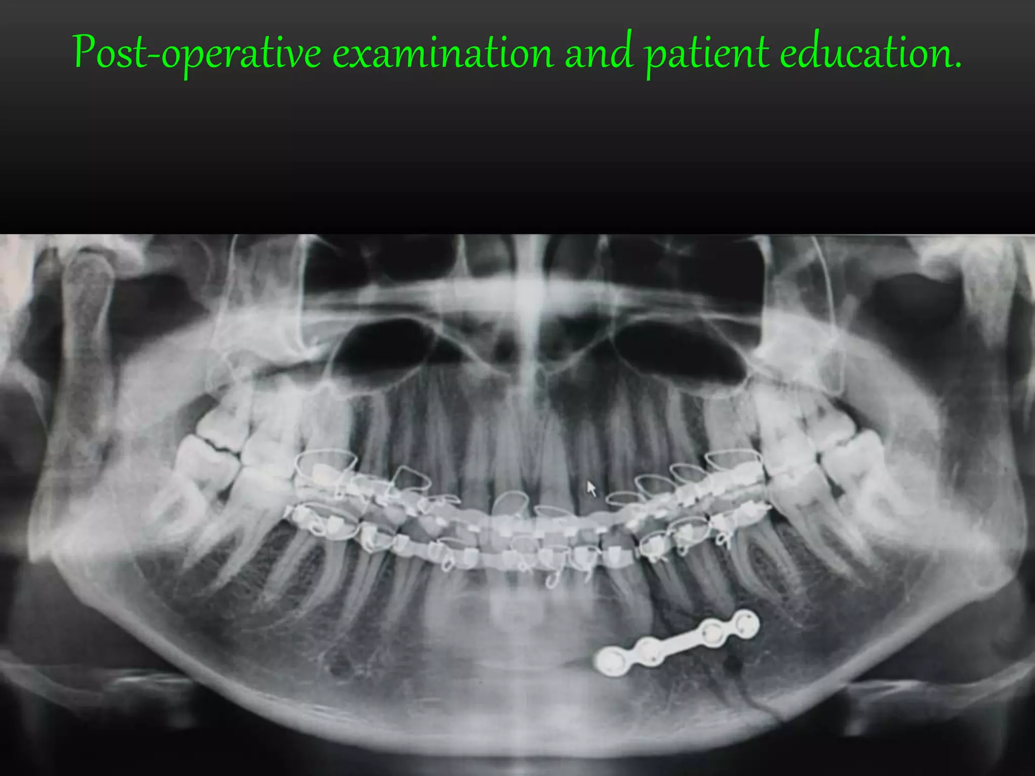 OPG and Extraoral radiography | PPTX
