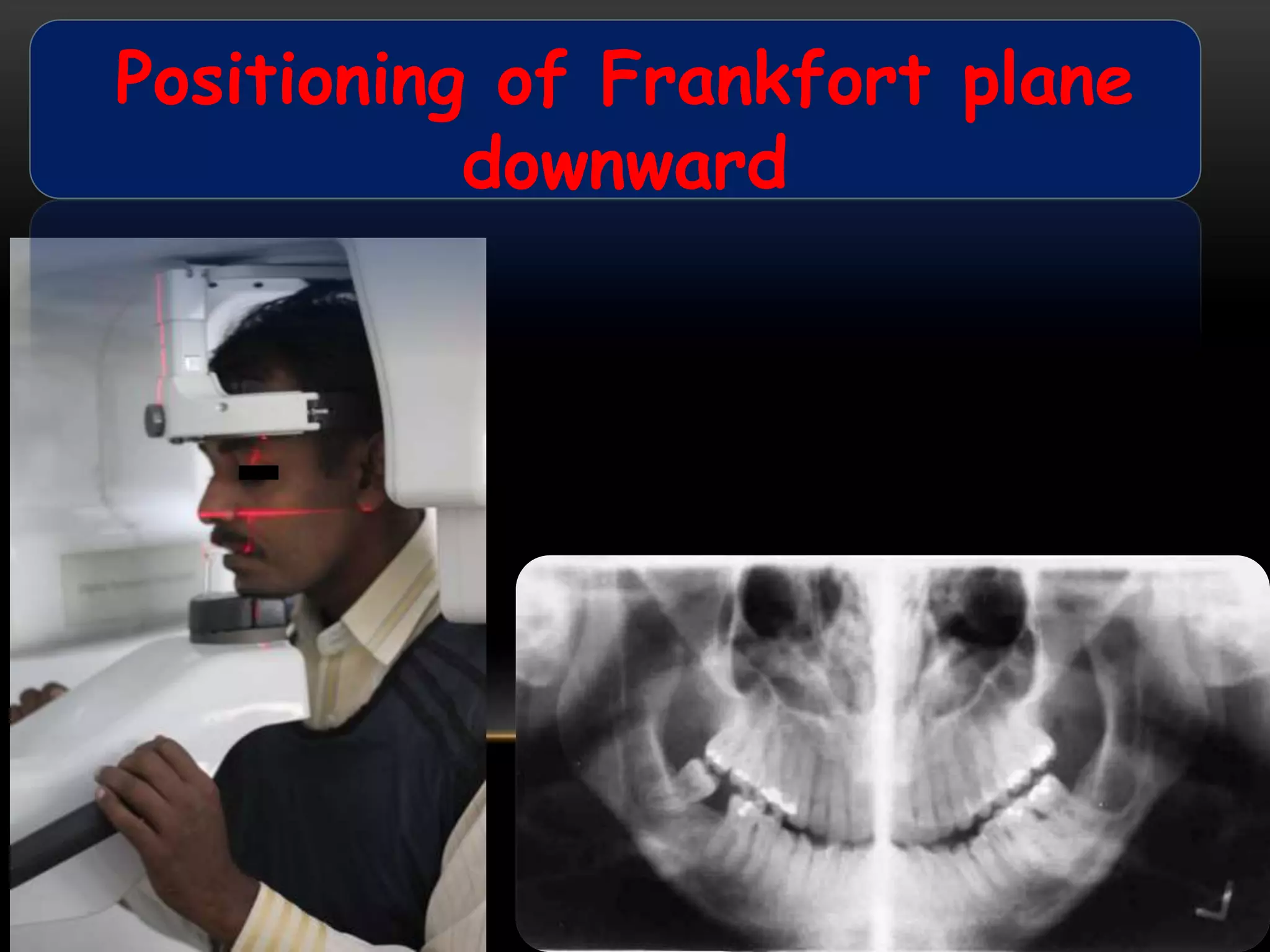 OPG and Extraoral radiography | PPTX