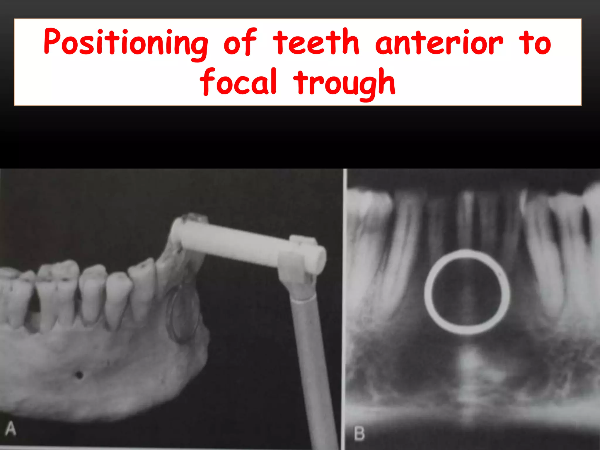 OPG and Extraoral radiography | PPTX