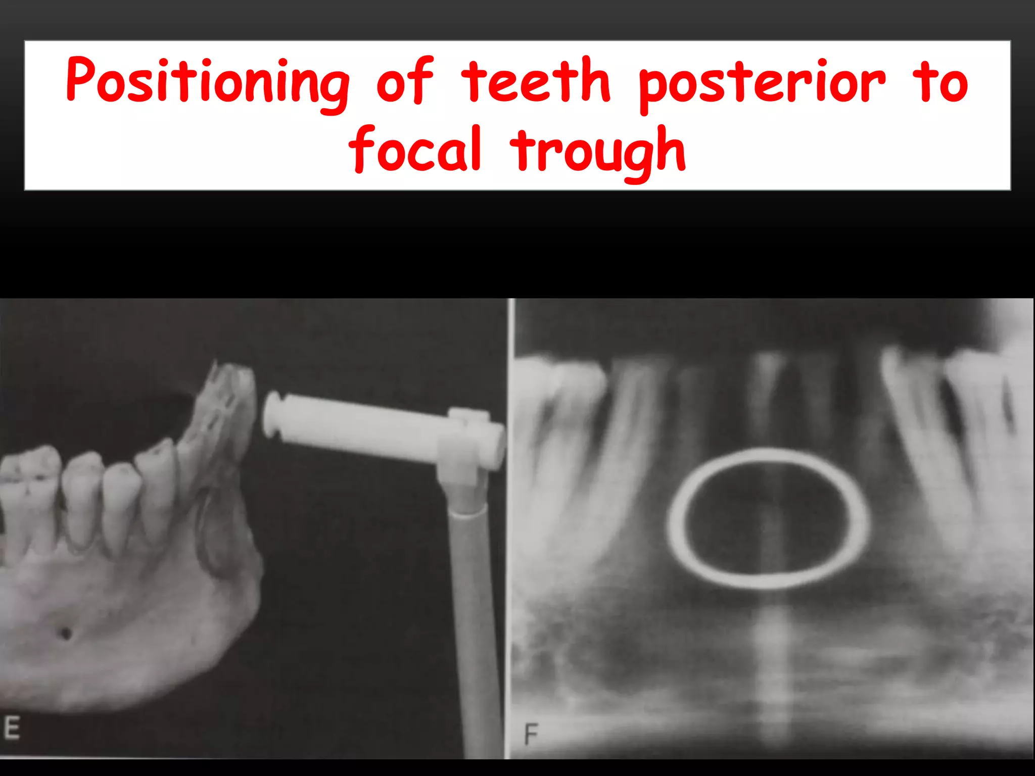 OPG and Extraoral radiography | PPTX