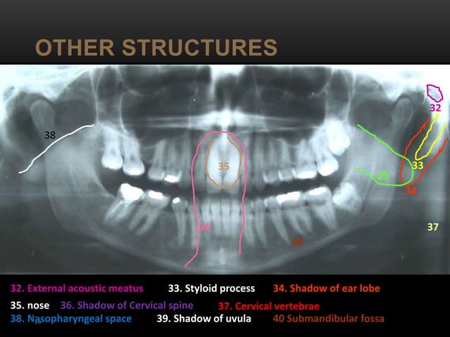 OPG and Extraoral radiography | PPTX