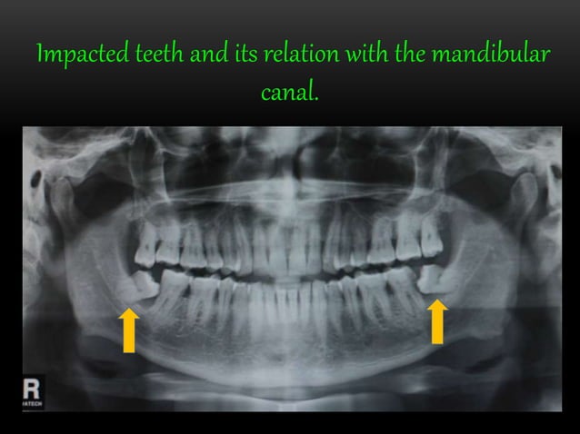 OPG and Extraoral radiography | PPTX