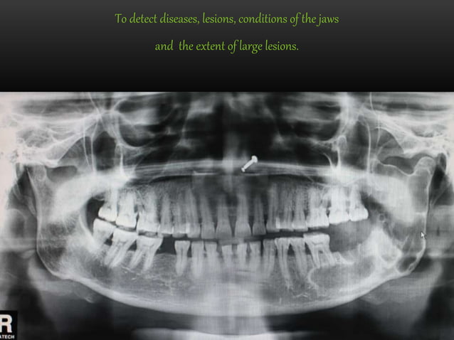 OPG and Extraoral radiography | PPTX